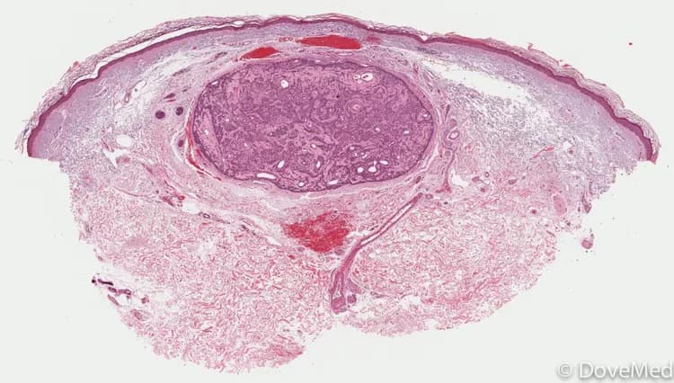 Glomus Tumor Of The Genitourinary System Dovemed