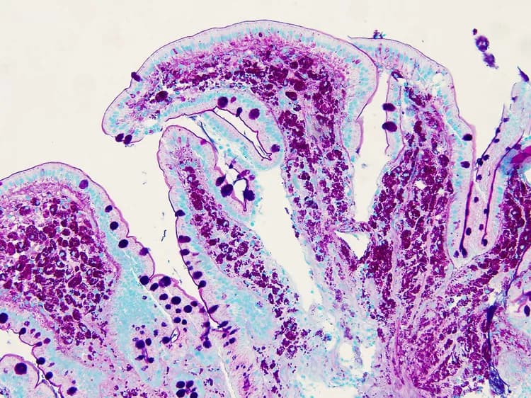 What is your diagnosis on this duodenal biopsy (PAS stain)? - DoveMed